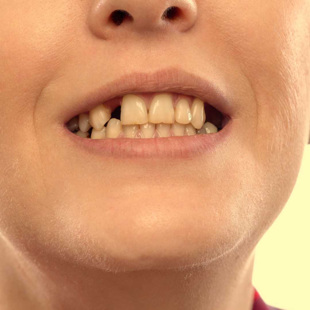 Broken Teeth Calgary Downtown | Dentalife